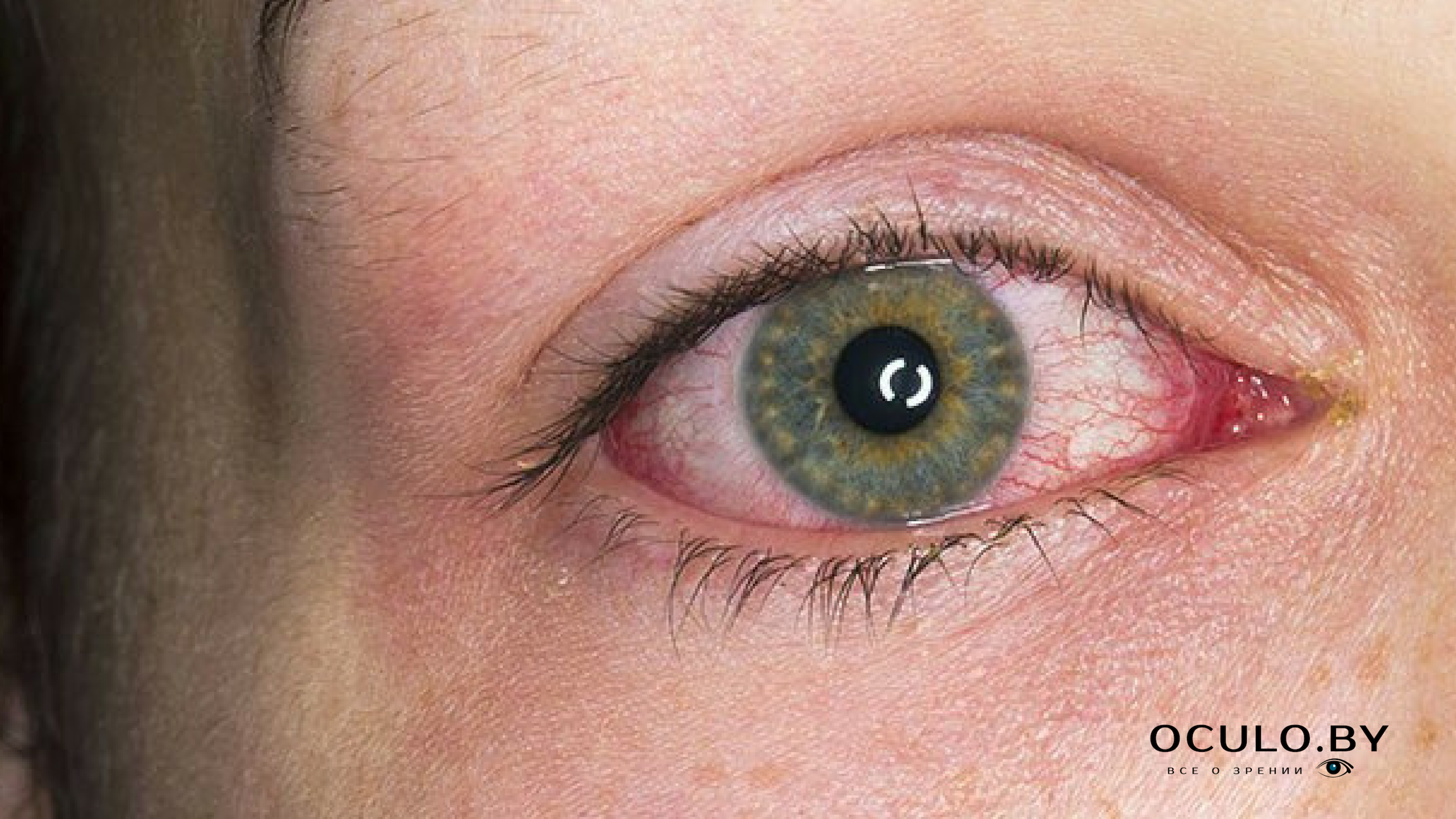 Увеит: причины, симптомы, лечение